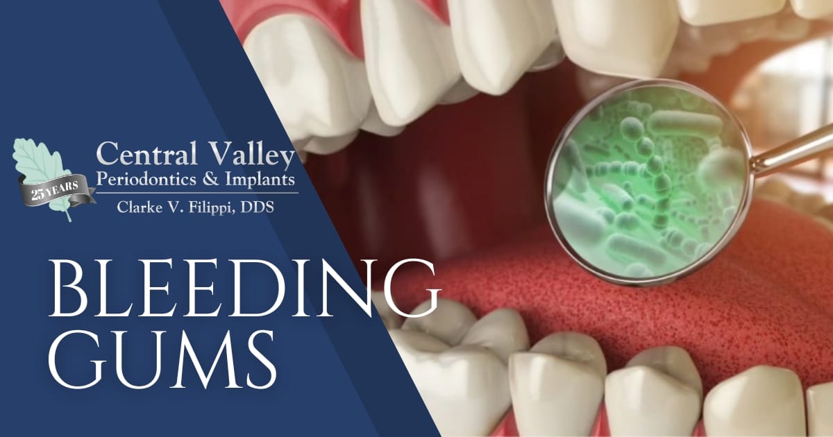 Bleeding Gums — Modesto, CA — Clarke V. Filippi, DDS