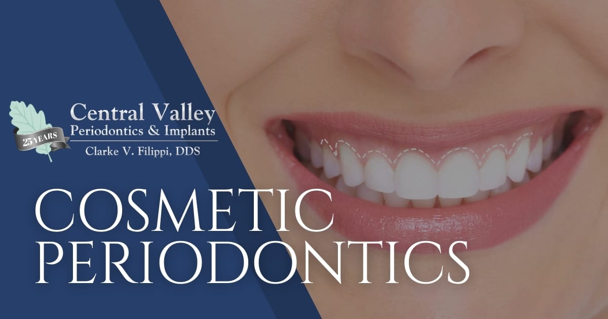 Cosmetic Periodontics — Modesto, CA — Clarke V. Filippi, DDS