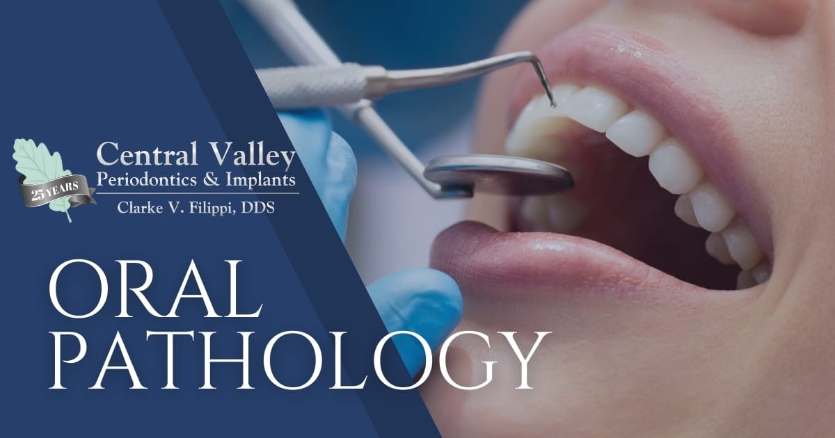 Oral Pathology — Modesto, CA — Clarke V. Filippi, DDS
