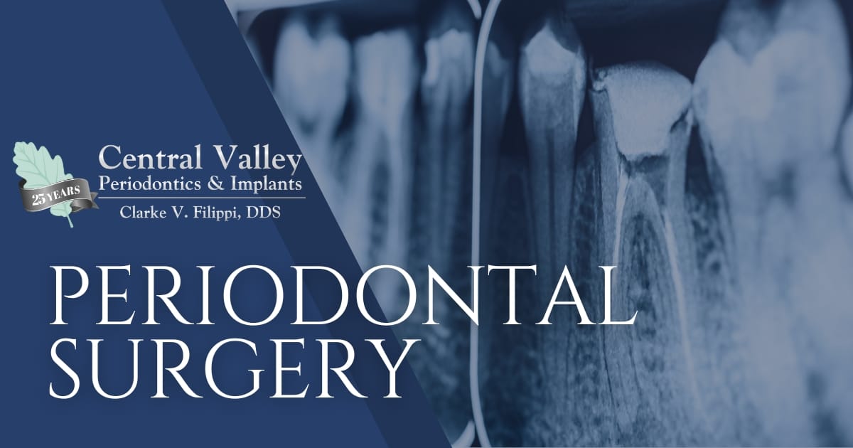 Periodontal Surgery — Modesto, CA — Clarke V. Filippi, DDS